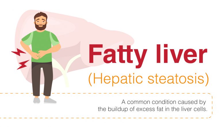 Overview of Fatty Liver: Signs, Symptoms, and Diagnosis