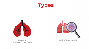 All about Tuberculosis – Types, Symptoms, Diagnosis, and More