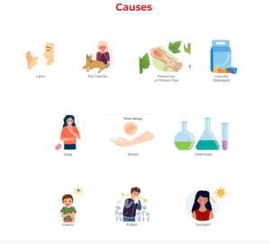 Skin Allergy - Types, Causes, Symptoms & Prevention | Lal PathLabs