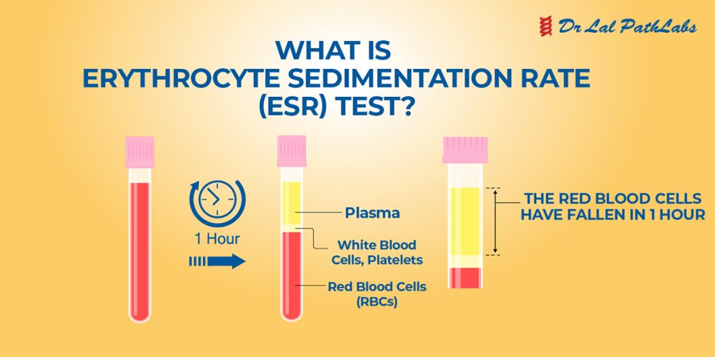 Understanding ESR Test and Erythrocyte Sedimentation Rate | Dr. Lal ...