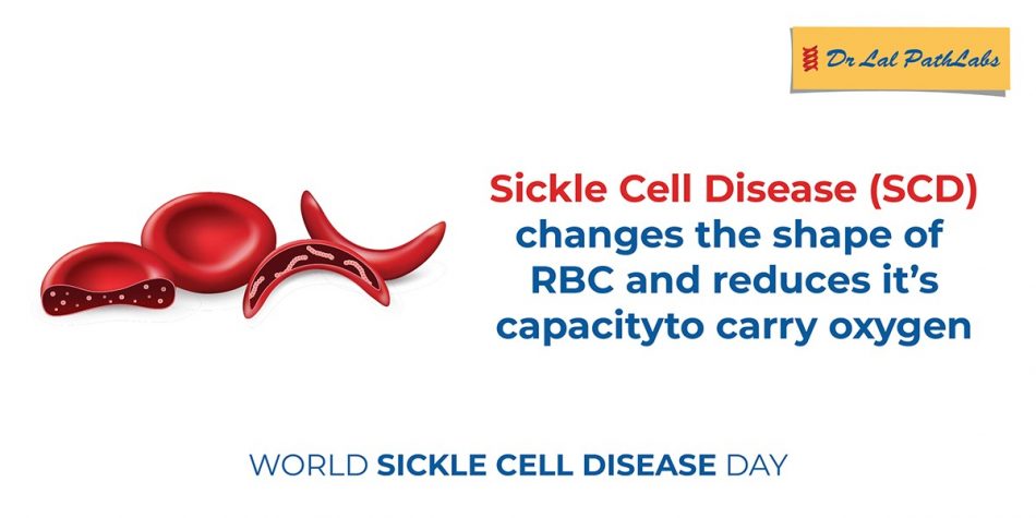 Sickle Cell Disease: Symptoms, Diagnosis and Effective Home Remedies ...