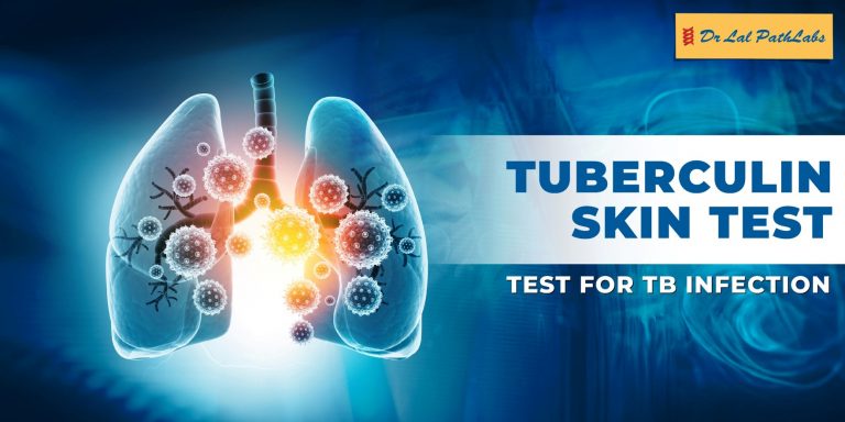 Tuberculin Test: Normal Range, Procedure, and Results | Dr Lal PathLabs